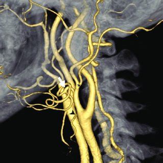 The Left Sided Three Dimensional Computed Tomographic Angiogram Of