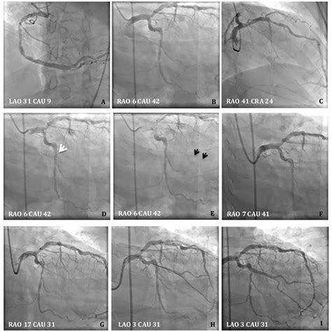 Diagnostic CAG Was Performed A C It Showed CAD SVD With Multiple Download Scientific Diagram