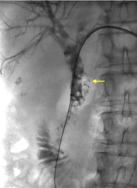 Figure 2 From Percutaneous Transhepatic Cholangioscopy With Intraductal Electrohydraulic