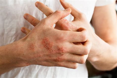 Bay Area Eczema Symptoms Treatments And Management Illustra