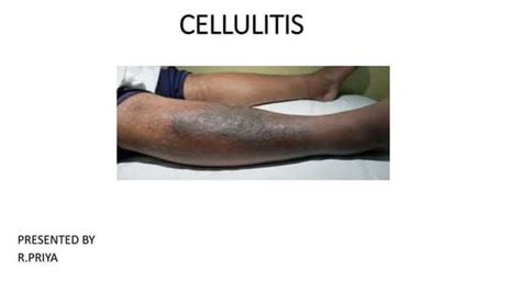Cellulitis Pptx