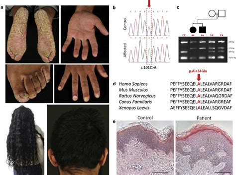 Recessive Mutation In Fam83g Associated With Palmoplantar Keratoderma