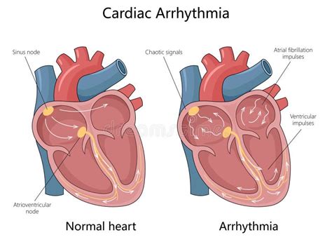 Normal Heart And Cardiac Arrhythmia Diagram Stock Illustration Illustration Of Anatomy Human