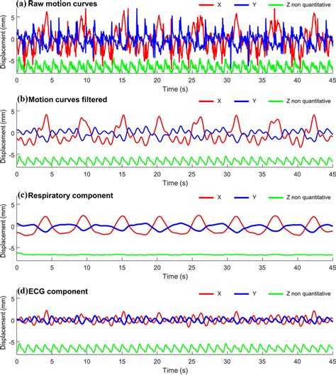 Motion Curves Obtained By Following The Catheter Micro Coils By Radon Download Scientific