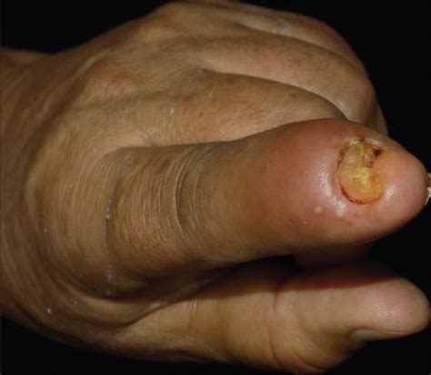 Periungual Deep Seated Granulomatous Pyoderma Gangrenosum Indian Journal Of Dermatology