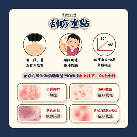 刮痧注意事項｜雲鼎中醫 院長 陳玫汝 醫師 臻觀中醫醫療體系