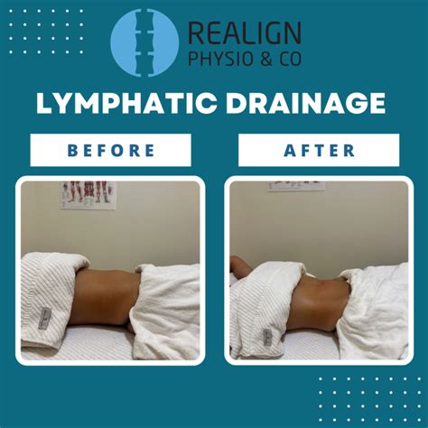 Lymphatic Drainage Realign Physio And Co