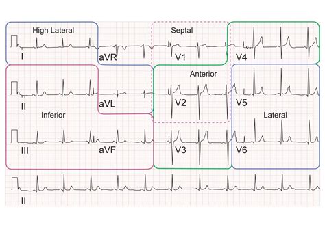 Telemetry And Ekg Basics Rhythm Recognition