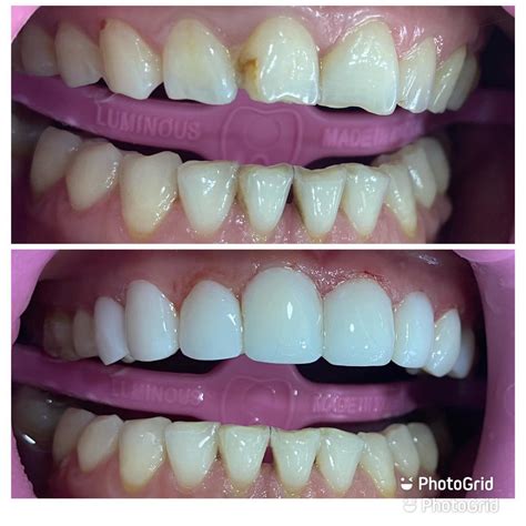 ШҮД 👩‍⚕️ Пааланг ямар шүдэнд тавих вэ 👩‍⚕️ Үүдэн Facebook