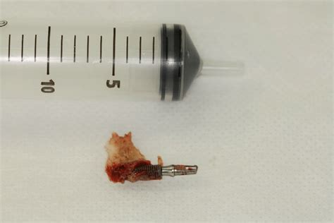 Implant And Bone Sequestration Download Scientific Diagram