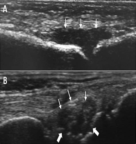Longitudinal Ultrasound Scan Of A The Second Metacarpophalangeal
