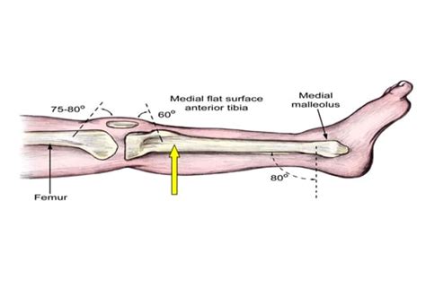 Proximal Tibia Io