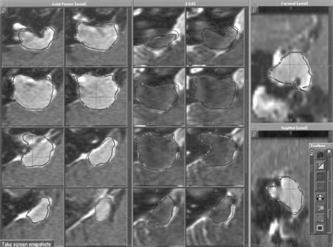 Stereotactic Radiosurgery And Radiotherapy Oncohema Key