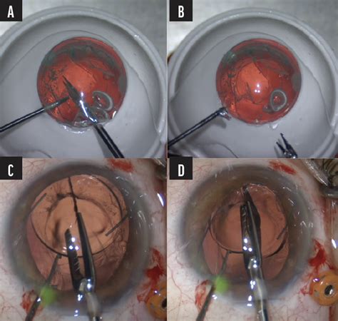 Crstoday Iol Properties Considerations For Lens Removal