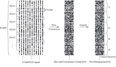 Table 1 From Two Dimensional Ecg Based Cardiac Arrhythmia Classi Cation Using Dse Resnet