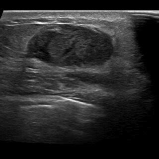 Ultrasound Image Of The Mass Demonstrated A Heterogeneous Oval Solid