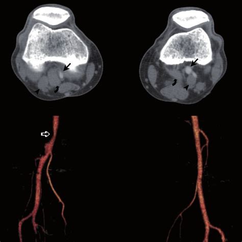 Axial Ct Angiography And Maximum Intensity Projections Mip Of The Download Scientific Diagram