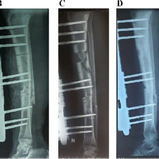 Male Years Old With Infected Non Union Of Right Shaft Tibia A Download Scientific Diagram