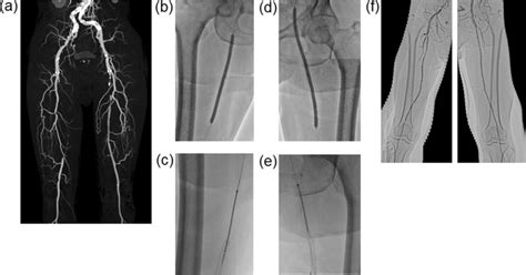 A Computed Tomography Ct Angiographic Image Showing Total Occlusion Download Scientific
