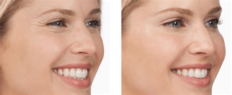 Botox® For Crows Feet In New York Ny
