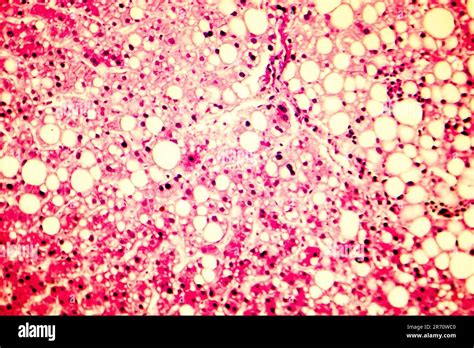 Fatty Liver Liver Steatosis Photomicrograph Showing Large Vacuoles Of Triglyceride Fat