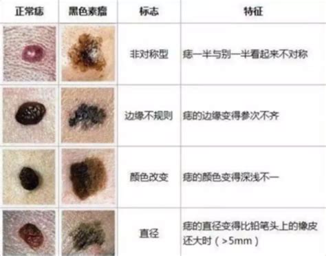 痦子癌变的征兆图片 痦子变大鼓起来了 容易变的痣的图片 第2页 大山谷图库