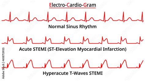 Set Of Ecg Common Abnormalities Acute Hyperacute Stemi St Elevation Myocardial Infarction