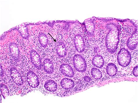 Infectious Disease Pathology Of The Gastrointestinal Tract Surgical