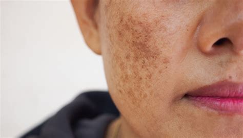 How Do I Get Rid Of Melasma Dark Patches On My Face Skinkraft