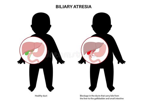 Biliary Atresia Disease Stock Illustration Illustration Of Treatment