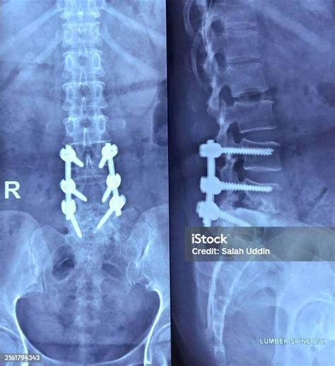 Rontgen Tulang Belakang Lumbosakral Spondylosis Lumbal Dengan