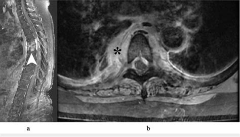 Mri Thoracic Spine T1 With Contrast In Sagittal A And Axial B