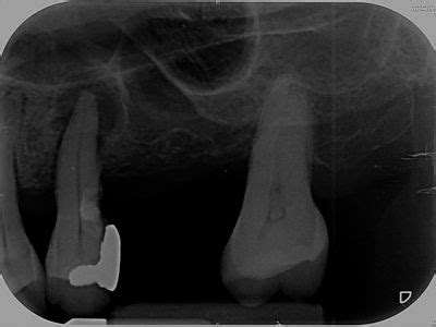 Tay Dental Surgery Tooth Pulp Disease