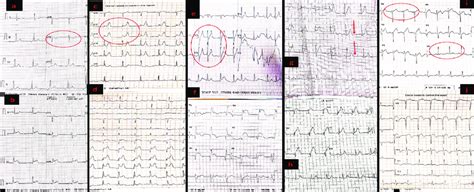A 12 Lead Electrocardiography Showing Negative T Wave In Lead Avl Download Scientific