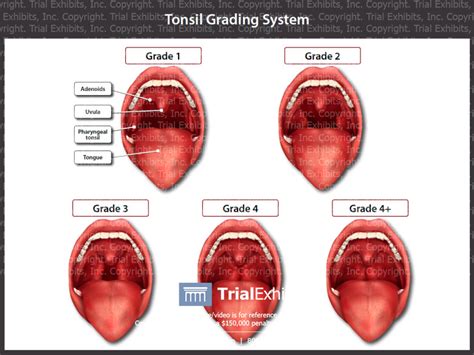 Tonsil Grading System Trial Exhibits Inc