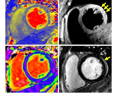 Cardiac Mri Of An Mis C Patient With Evidence Of Myocarditis A T2 Map