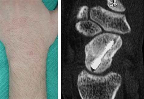 Mini Open Reduction And Internal Fixation Of Acute Scaphoid Fracture Thomas R Hunt Iii M D
