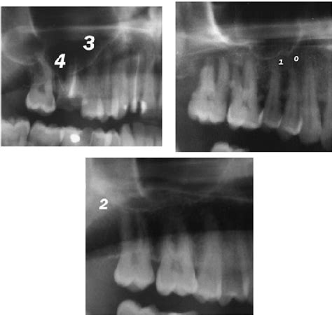 Parts Of Panoramic Radiographs Showing Relation Scores To The Maxillary Download Scientific