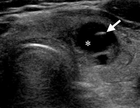 The Thyroid Review Of Imaging Features And Biopsy Techniques With