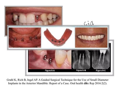 Classification And Types Of Craniofacial Implants Pptx