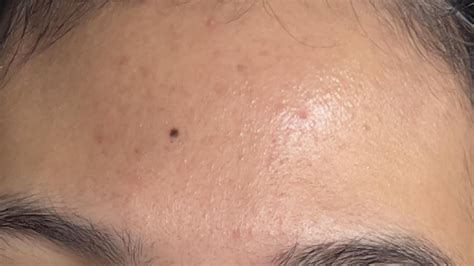 How To Get Rid Of Fungal Acne On Forehead Without Products Youtube