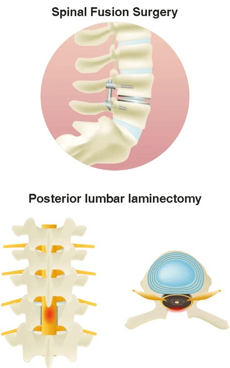 Ilcs Treatment For Degenerative Lumbar Scoliosis International