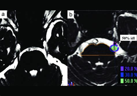 Trigeminal Nerve Mri Sagittal