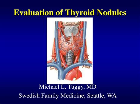 Ppt Evaluation Of Thyroid Nodules Powerpoint Presentation Free