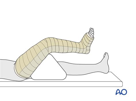 Splinting