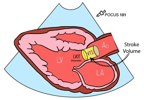 Measuring Cardiac Output With Echocardiography Made Easy Pocus 101