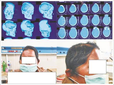 Patient Presenting Gcs Of 6 Underwent A Right Side Hemicraniectomy Download Scientific Diagram