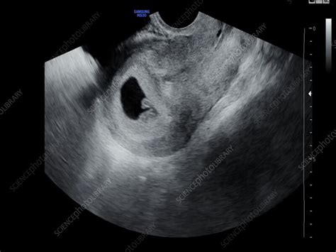 7 Week Old Embryo Transvaginal Ultrasound Scan Stock Video Clip