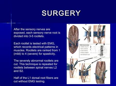 Surgical Therapies For Spasticity Ppt