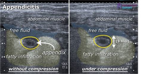 Abdominal Ultrasound